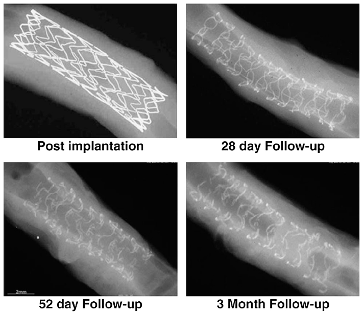 Bio-Adaption between Magnesium Alloy Stent and the Blood Vessel: A Review
